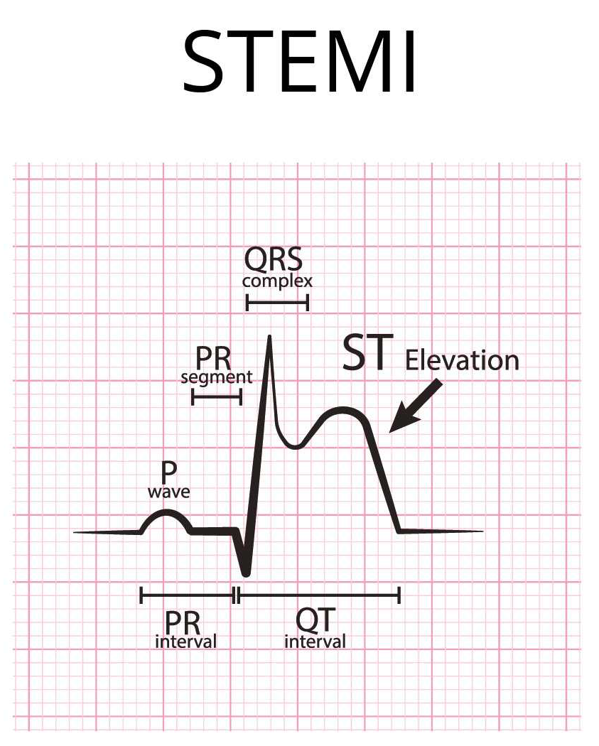 STEMI | Rettungsdienst | Repetico